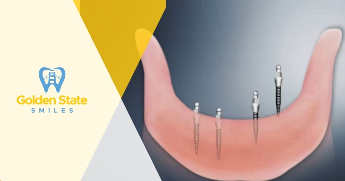 Mini Dental Implants | Golden State Smiles, Concord, San Leandro